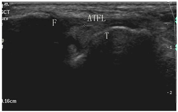 An Ultrasound Classification of Anterior Talofibular Ligament (ATFL) Injury