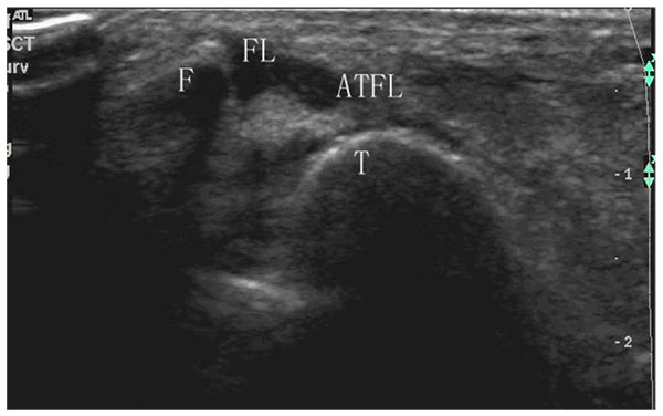 An Ultrasound Classification of Anterior Talofibular Ligament (ATFL) Injury