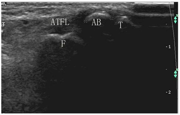 An Ultrasound Classification of Anterior Talofibular Ligament (ATFL) Injury