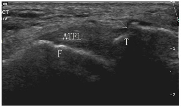 An Ultrasound Classification of Anterior Talofibular Ligament (ATFL) Injury