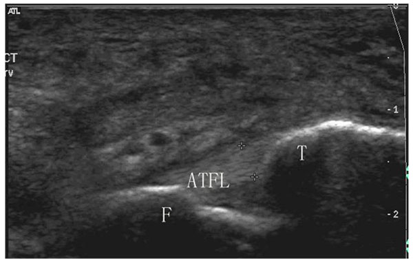 An Ultrasound Classification of Anterior Talofibular Ligament (ATFL) Injury