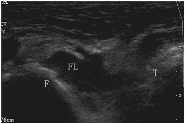 An Ultrasound Classification of Anterior Talofibular Ligament (ATFL) Injury