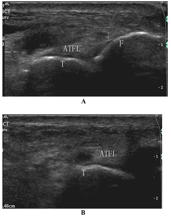 An Ultrasound Classification of Anterior Talofibular Ligament (ATFL) Injury