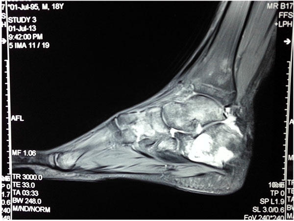Role of Surgery in Management of Osteo-Articular Tuberculosis of the ...