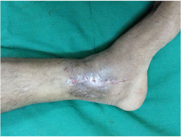 Role of Surgery in Management of Osteo-Articular Tuberculosis of the ...