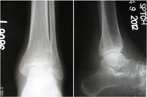 Role of Surgery in Management of Osteo-Articular Tuberculosis of the ...