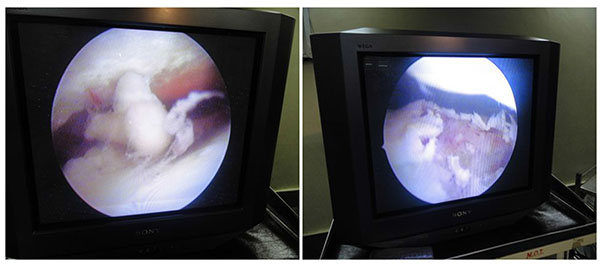 Role of Surgery in Management of Osteo-Articular Tuberculosis of the ...