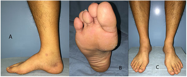 Reconstruction of Cavus Foot: A Review