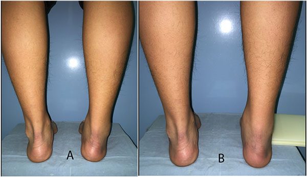Reconstruction of Cavus Foot: A Review