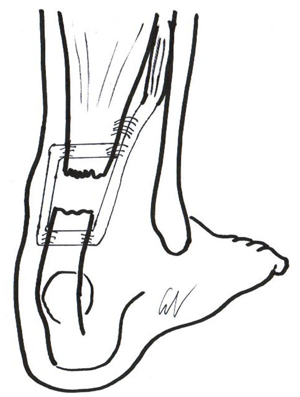 Fig. (4). Final appearance of the peroneus brevis tendon transfer.