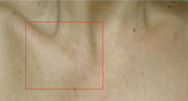 SAPHO Syndrome Diagnosis and Treatment: Report of Five Cases and Review ...