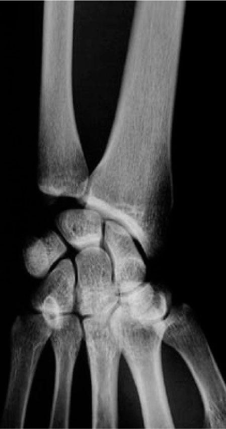 SAPHO Syndrome Diagnosis and Treatment: Report of Five Cases and Review ...