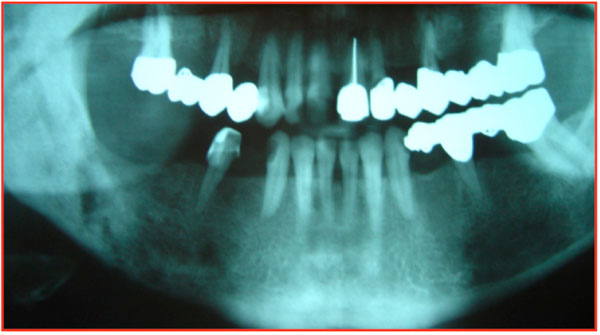 SAPHO Syndrome Diagnosis and Treatment: Report of Five Cases and Review ...
